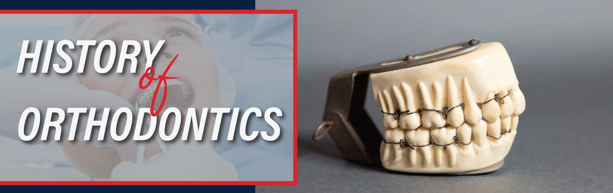 Orthodontic Instruments: Names, Uses, and History